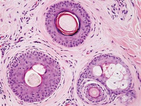 Inflammatory Diseases Of Hair Follicles Sweat Glands And Cartilage