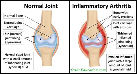 Inflammatory Arthritis Orthoeducation