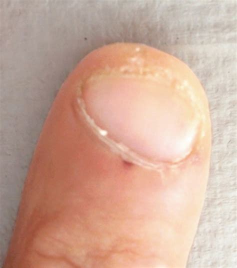 How To Diagnose Quincks Disease Pregnant Center Informations