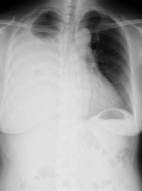 Pleural Effusion From Pleuroperitoneal Communication Pmc