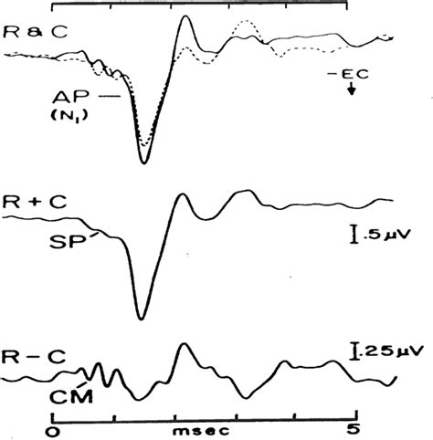 Electrocochleography Semantic Scholar