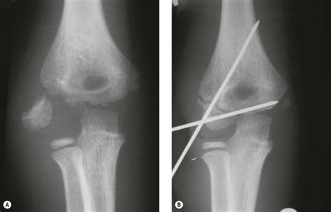 Lateral Condyle Fracture Milch