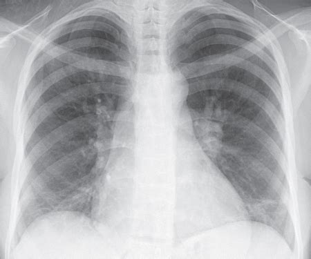 Acute Chest Syndrome Sickle Cells Ouvyj