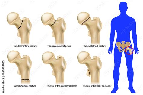 Vector De Stock Femoral Neck Fracture Types Of Hip Fractures