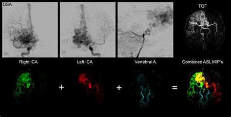 Superselective Pseudo Continuous Arterial Spin Labeling Angiography European Journal Of Radiology