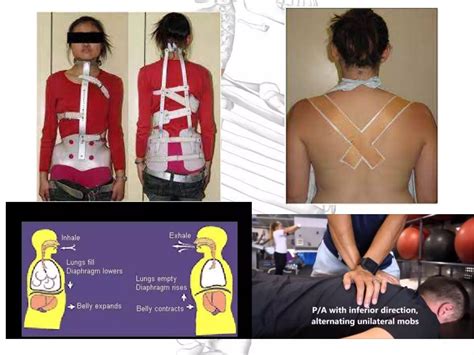 Thoracic Kyphosis Thoracic Hyperkyphosis Pptx Death Injury Or