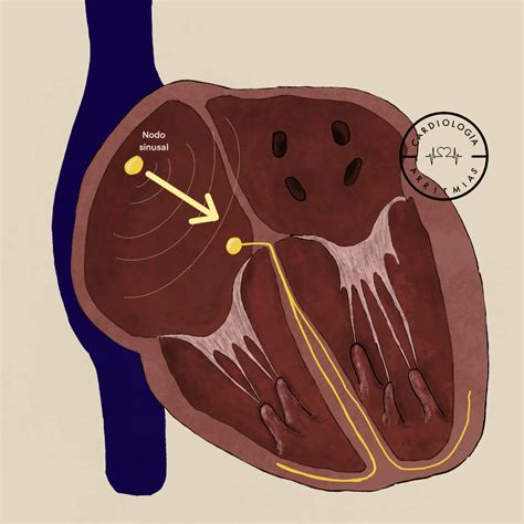 ¿qué Son Las Extrasístoles Ventriculares 2026