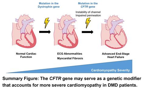 Genetic Mutation Could Worsen Heart Function In Duchenne Muscular Dystrophy Patients