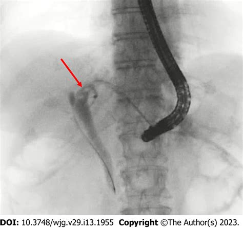 Case Of Total Gastrectomy With Ry Reconstruction Enteroscopy Assisted Download Scientific