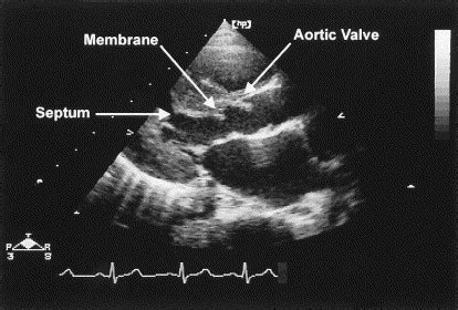 Subaortic Stenosis At Risk Substrates And Treatment Strategies
