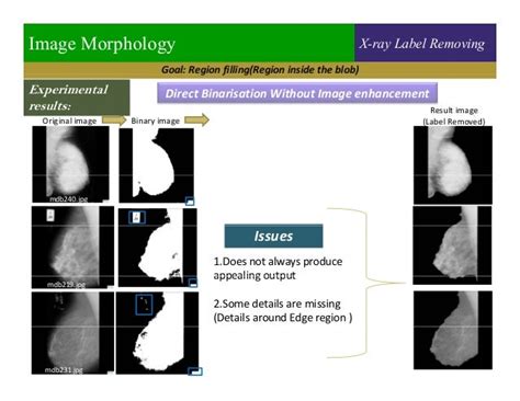Microcalcification Identification In Digital Mammogram For Early Dete