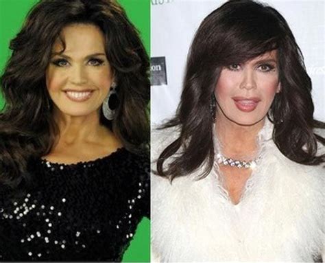 Pin On Celebrity Surgery