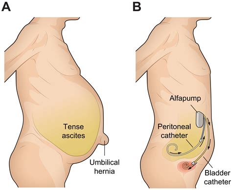 Innovative Approaches To The Management Of Ascites In Cirrhosis Jhep