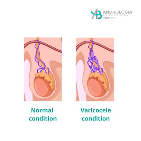 Microsurgical Treatment Of Varicocele Andrología Barcelona
