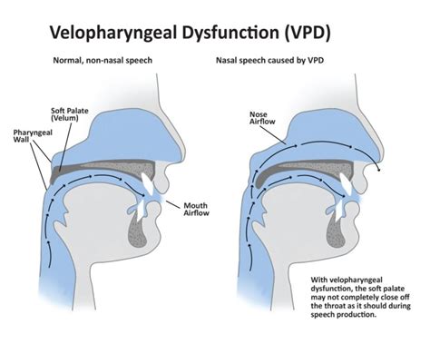 Velopharyngeal Dysfunction Vpd Diagnosis Treatment