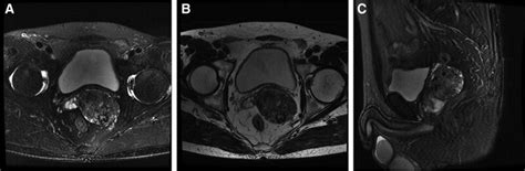 Primary Synovial Sarcoma And Acinar Adenocarcinoma Of Prostate Rarely