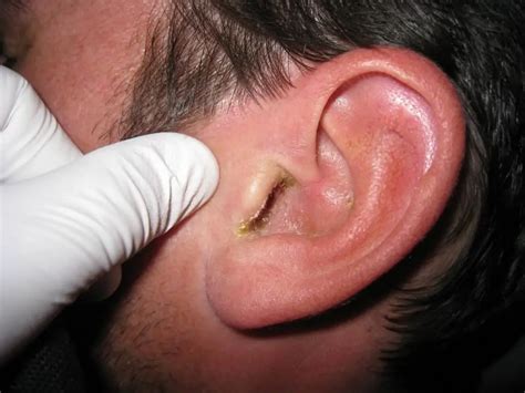 Symptoms Of Otitis Media In Adults Diseases And Conditions