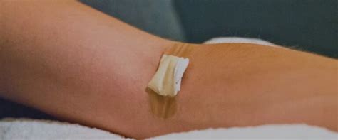 How To Manage Allergy To Adhesive Bandages And Tapes My Healthy Balance