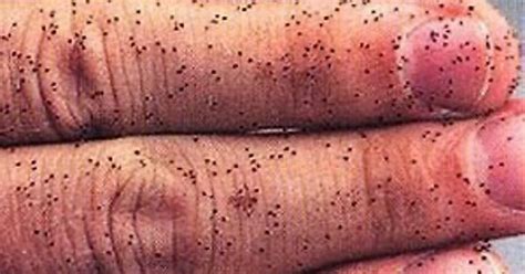 Bird Mite Infestation Imgur