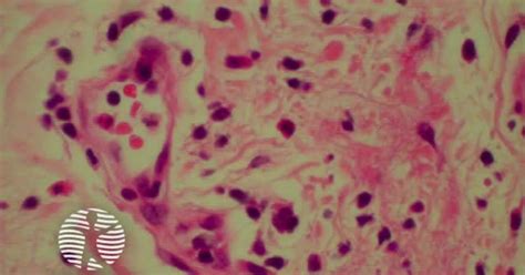 Bullous Pemphigoid Image