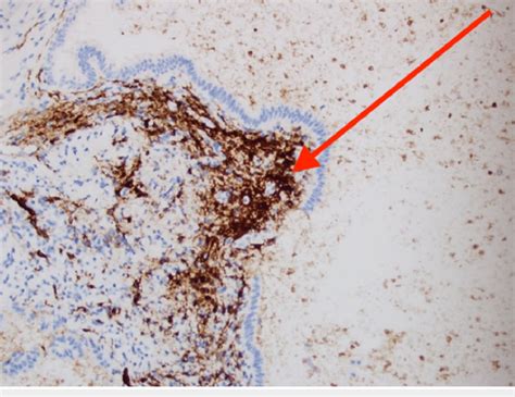 Pericystic Stromal Tissue Focally Positive For Cd10 Immunostain