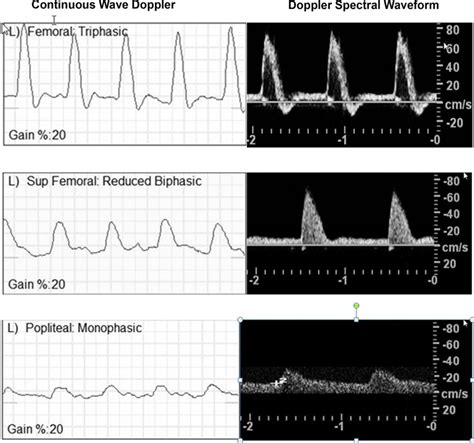 Arterial Waveform Medical Ultrasound Ultrasound Vascular Ultrasound