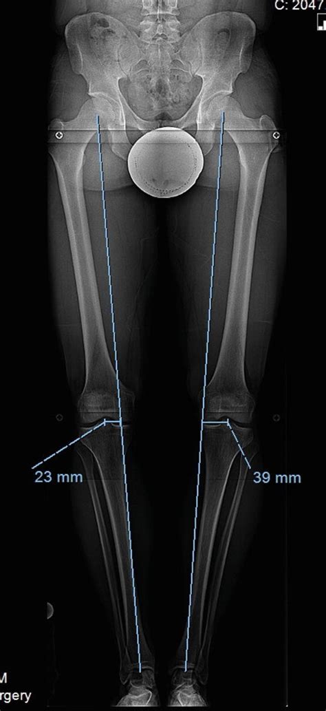Correction Of Bilateral Genu Varum For A High Level Athlete Springerlink