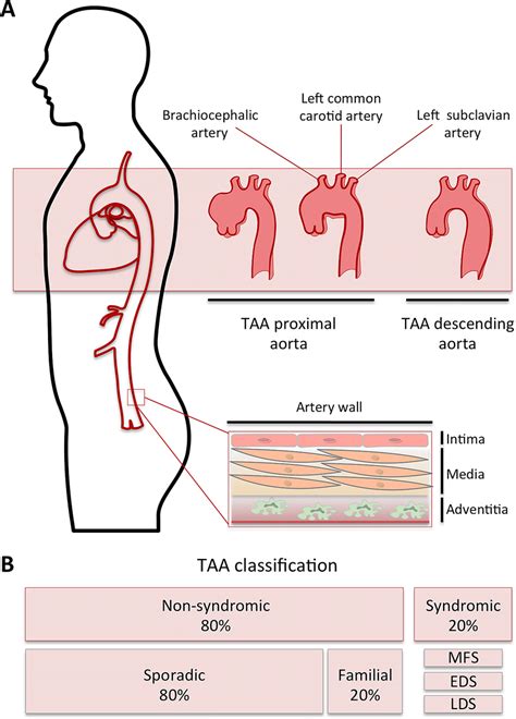 A Taa Subtypes Based On Localization Within The Aortic Tree Within