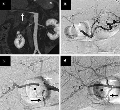 Hepatic Artery Emboli Causing Fulminant Hepatitis Journal Of Vascular