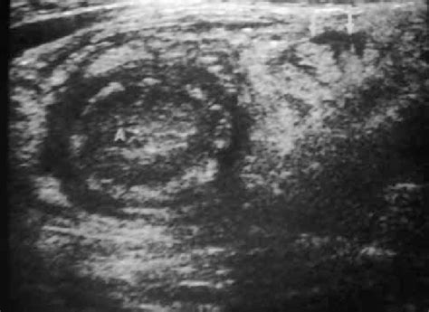 Us Image Showes Thick Walled Dilated Appendix A With Mesenteric