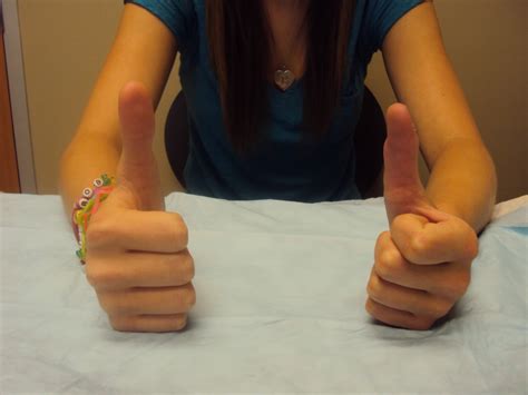 Thumb Duplication Hand And Wrist Surgery Cypress Tomball Katy