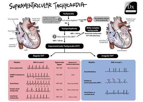 Types Of Ventricular Rhythms Types Of Ventricular Arrhythmias Suguh