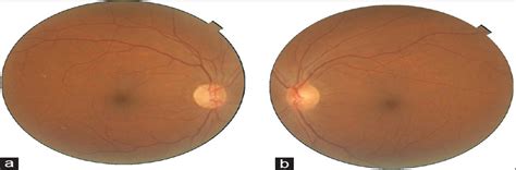 Indian Journal Of Ophthalmology