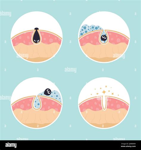 Popped Pimple Diagram