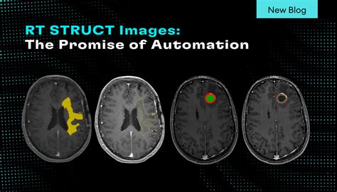Age Dependent Cutoffs For Pathological Brain Volume Loss Cortechsai
