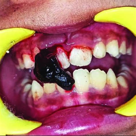 Liver Clot In Mouth At Loren Bona Blog