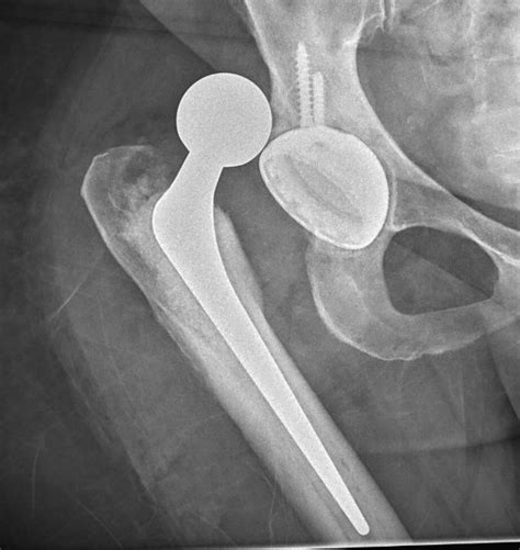 Dislocation The Bone School