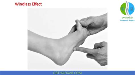 Windlass Test Plantar Fasciitis Examination Explained Easily Orthofixar