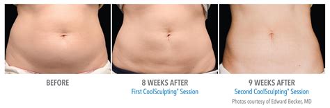 Coolsculpting Recovery And Treatment Coolsculpting Fat Freezing