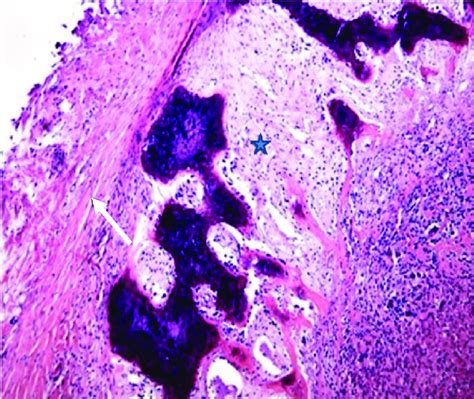 Histopathological Examination Shows Spaces Separated By Fibrous Septa