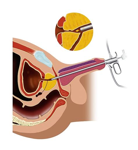 Prostate Gland Surgery Artwork Greeting Card By Science Photo Library