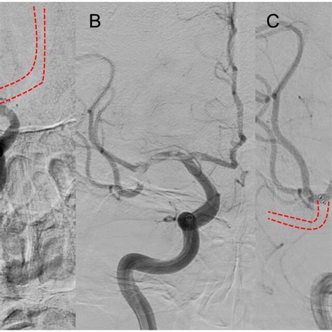 Branching Site Occlusion A Intracranial Carotid Artery Occlusion