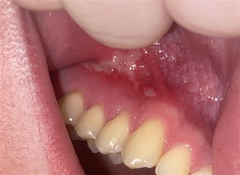 Gum Patch On Upper Gum Rdentalhygiene