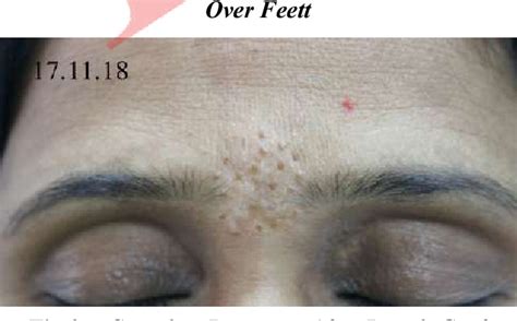 Figure 2 From A Case Of Chemical Leukoderma Effectively Treated With Punch Graft Surgery