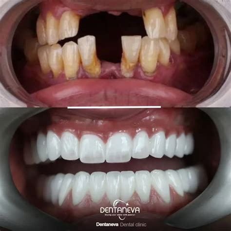 Front Dental Implants 5 Key Facts For Confidence