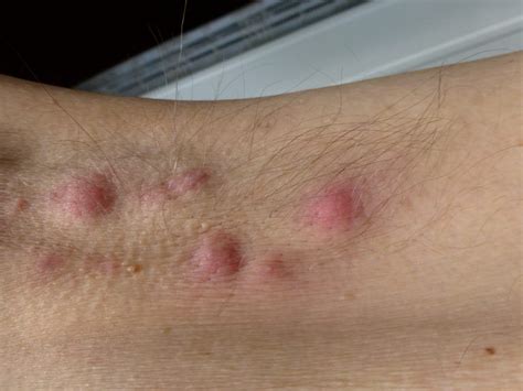 Acne Inversa Hidradenitis Suppurativa Definition Causes And Treatment
