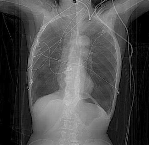 Faces Of Hyperinflation The Common Vein