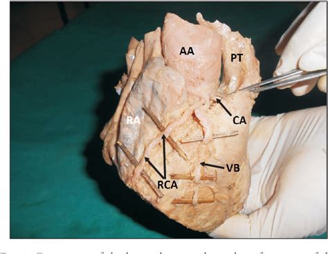 Figure 1 From Trifurcation Of Right Coronary Artery And Its Huge Right