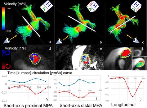 Streamline Imaging Flows Of The Pulmonary Arteries Of A 40 Year Old Man