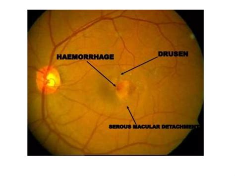 Pigment Epithelial Detachment Ped Pptx